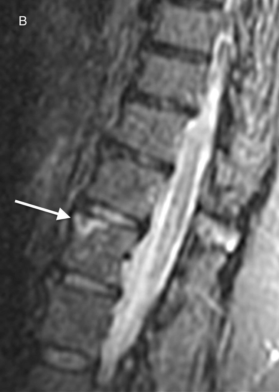 Spinal Cord Infarction - MD Searchlight