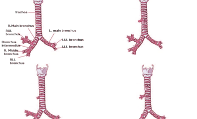 Tracheal Bronchus - MD Searchlight