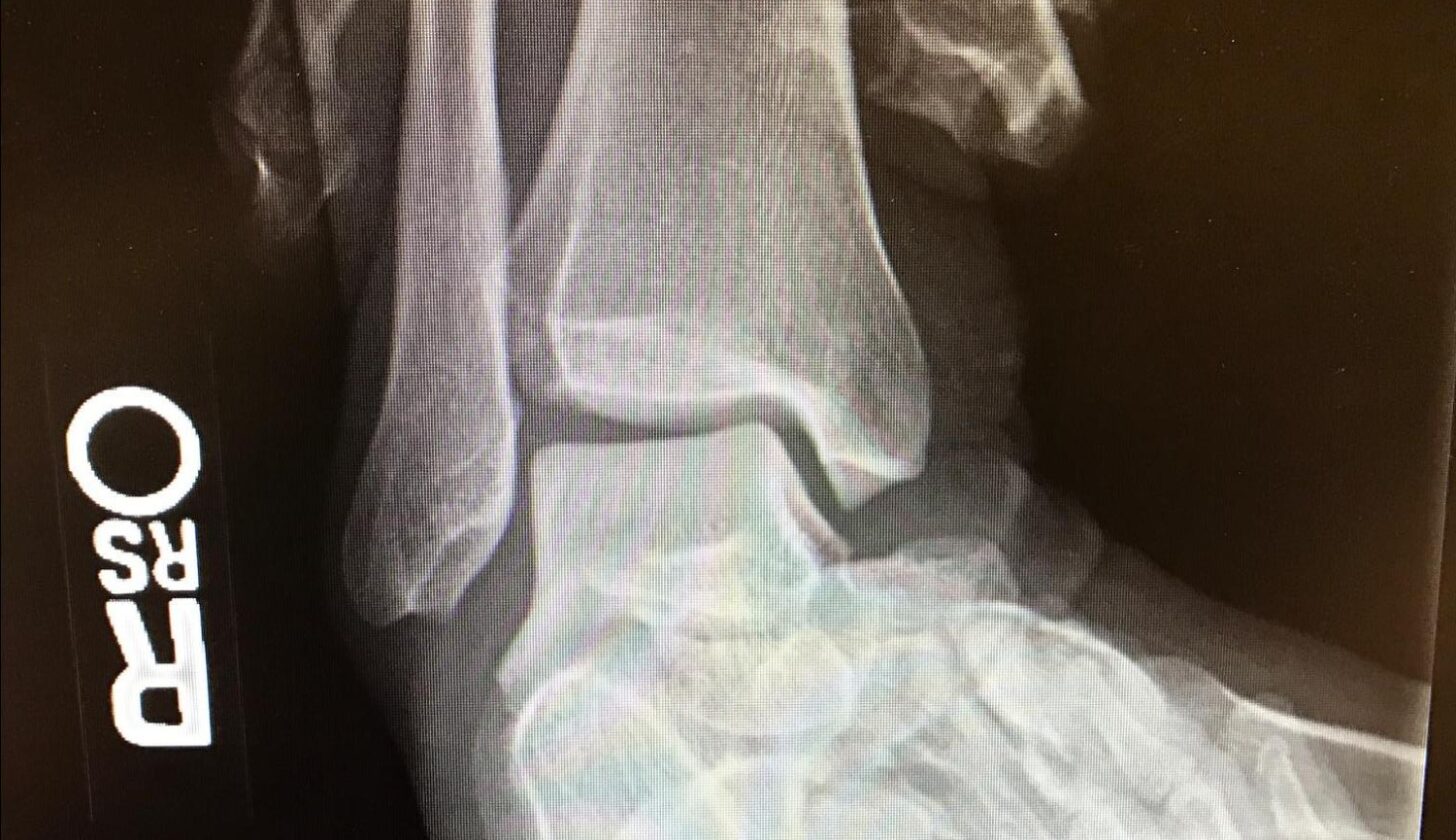Recurrent Ankle Sprain - MD Searchlight