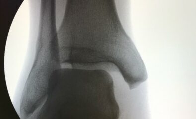 Recurrent Ankle Sprain - MD Searchlight