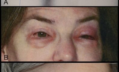 Blepharochalasis Syndrome - MD Searchlight