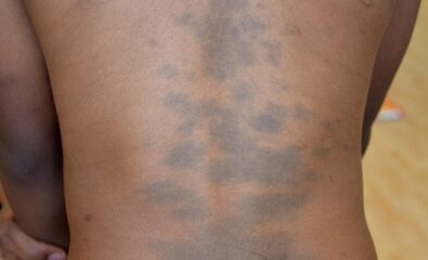 Blue Nevus - MD Searchlight