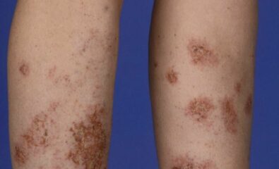 Nummular Dermatitis (Nummular Eczema) - MD Searchlight