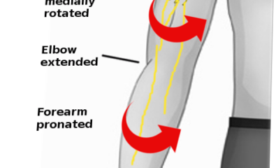Erb Palsy - MD Searchlight