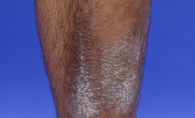 Lichen Simplex Chronicus - MD Searchlight