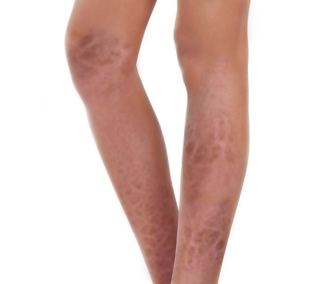 Nephrogenic Systemic Fibrosis - MD Searchlight