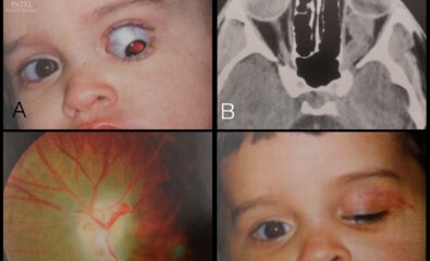 Optic Atrophy - MD Searchlight
