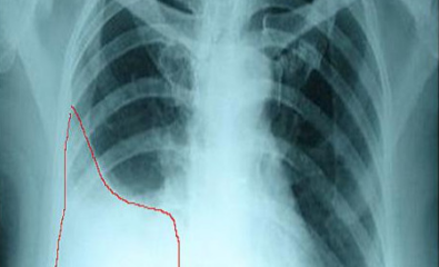 Parapneumonic Pleural Effusions and Empyema Thoracis - MD Searchlight