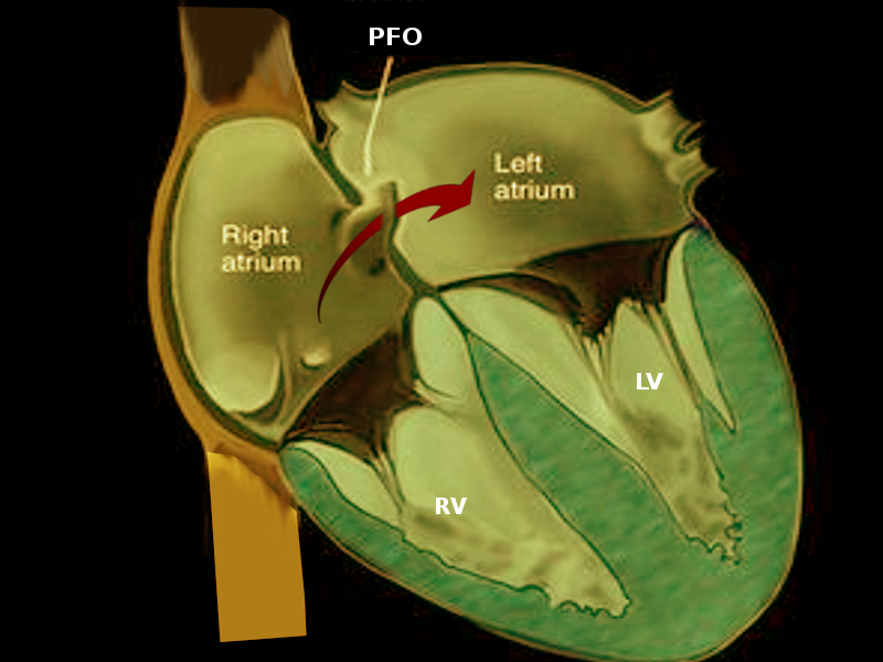 Patent Foramen Ovale - MD Searchlight