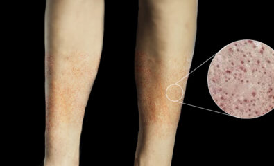Petechiae - MD Searchlight