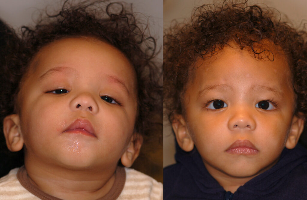 Ptosis - MD Searchlight