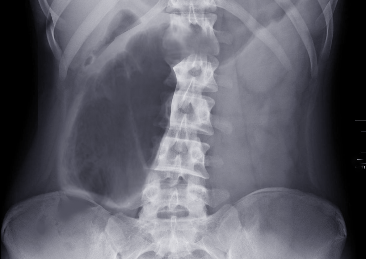 Volvulus - MD Searchlight