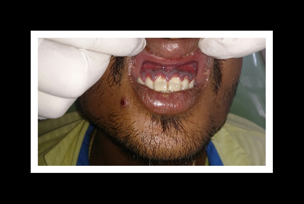 Necrotizing Periodontal Diseases - MD Searchlight