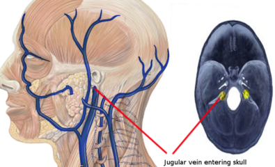Jugular Foramen Syndrome - MD Searchlight