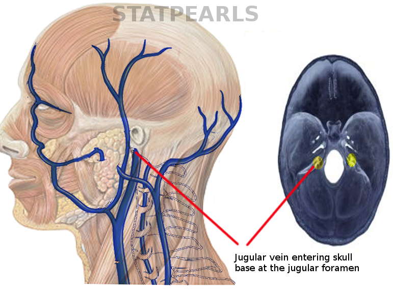 Jugular Foramen Syndrome - MD Searchlight