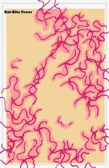 Rat-Bite Fever - MD Searchlight