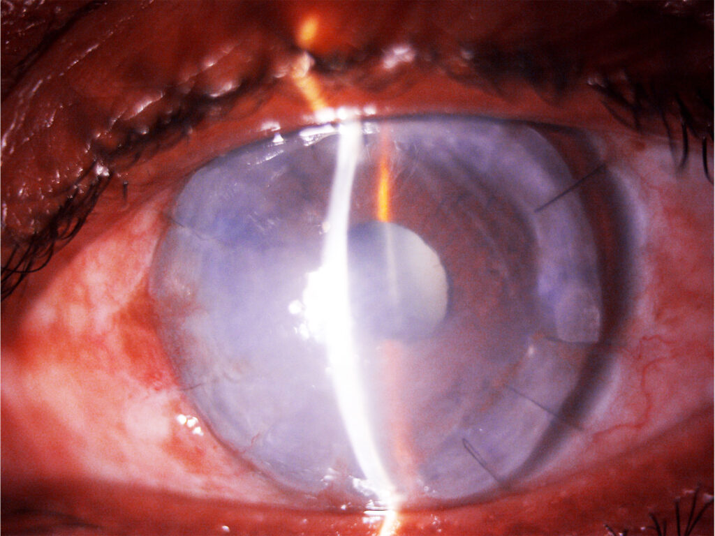 Pythium Keratitis - MD Searchlight