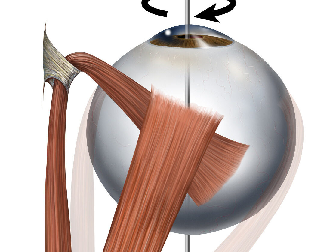 Superior Oblique Myokymia - MD Searchlight