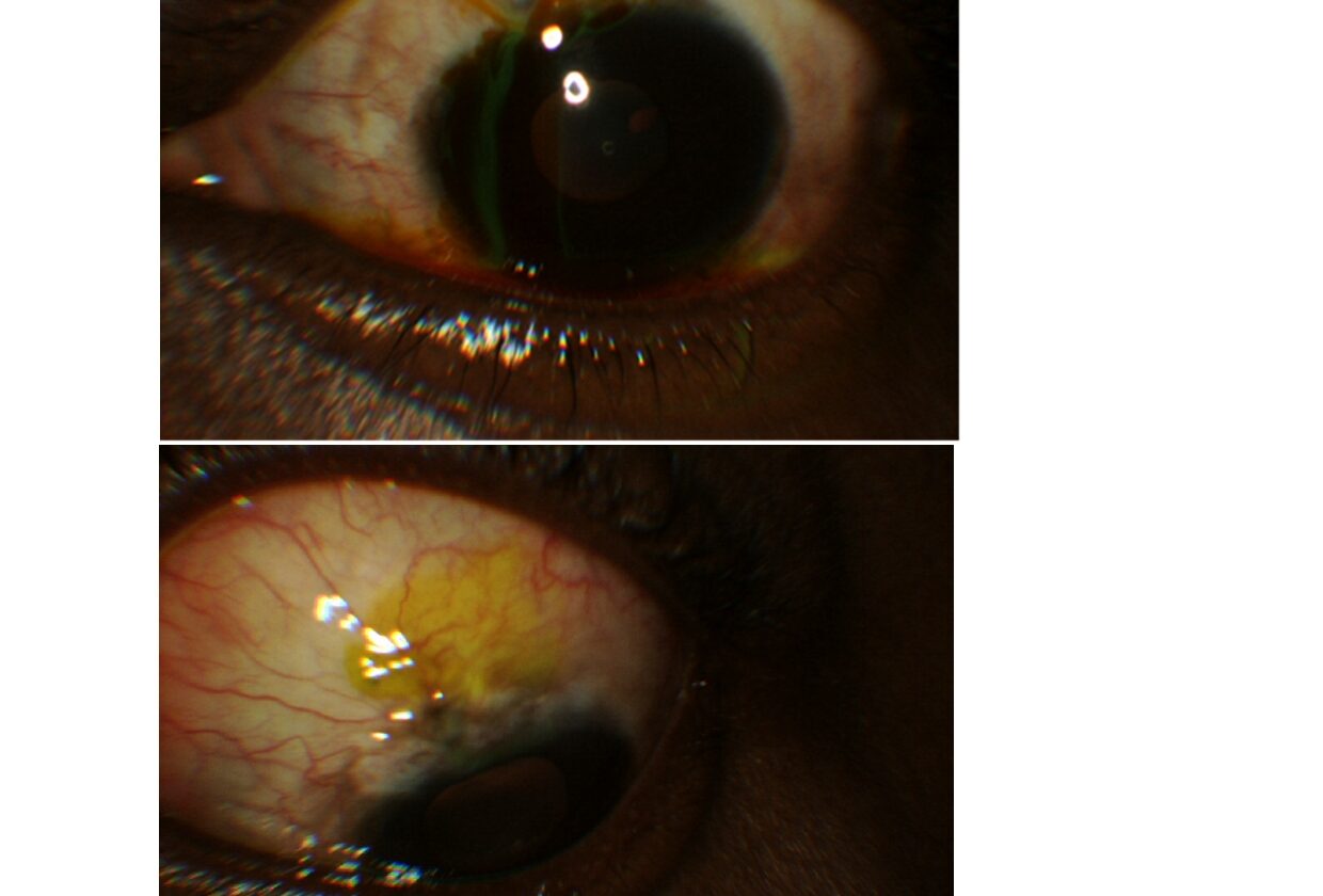 Ocular Hypotony - MD Searchlight