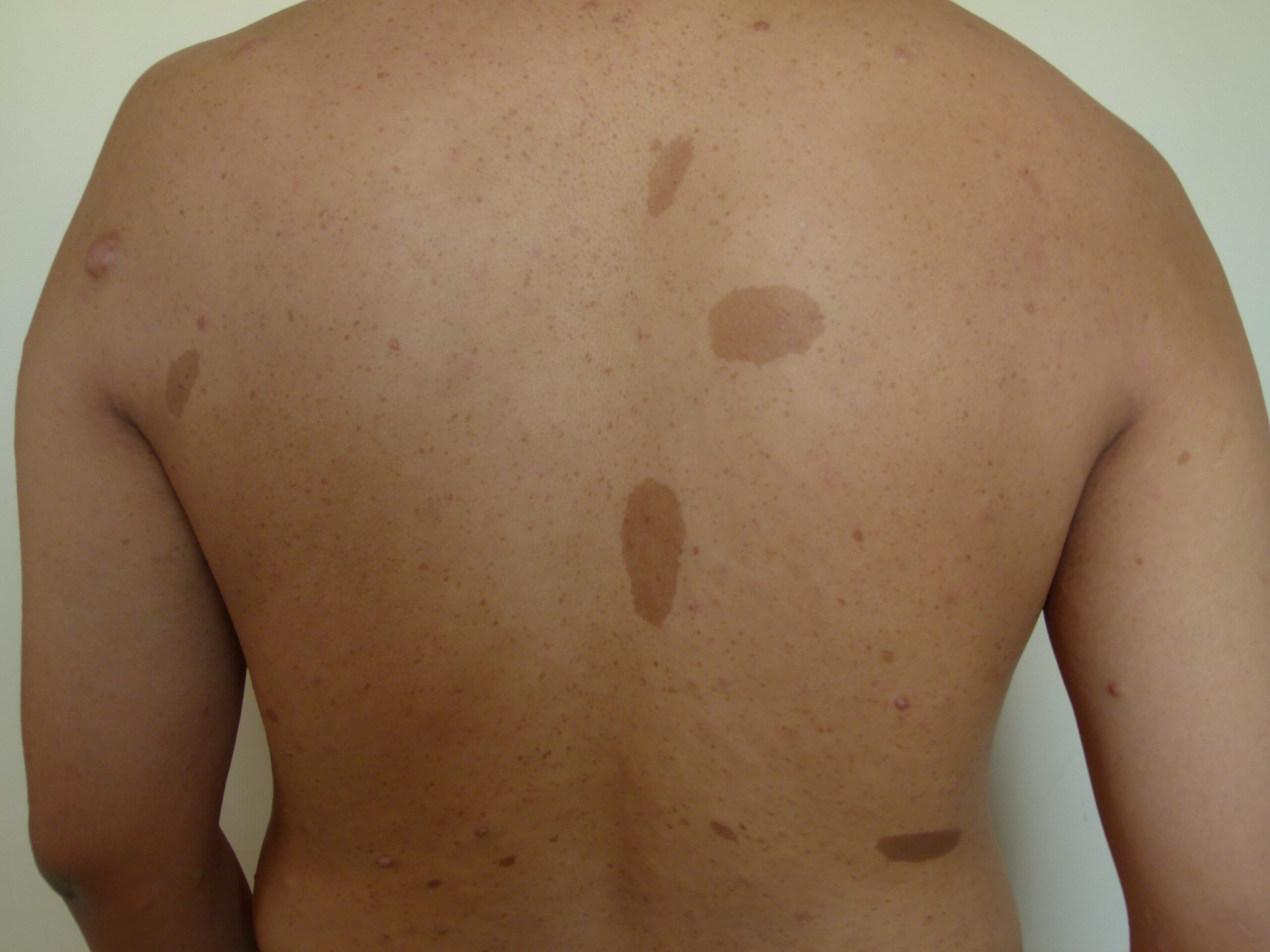 Neurocutaneous Syndromes - MD Searchlight