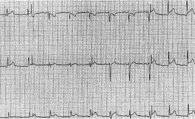 Uremic Pericarditis - MD Searchlight