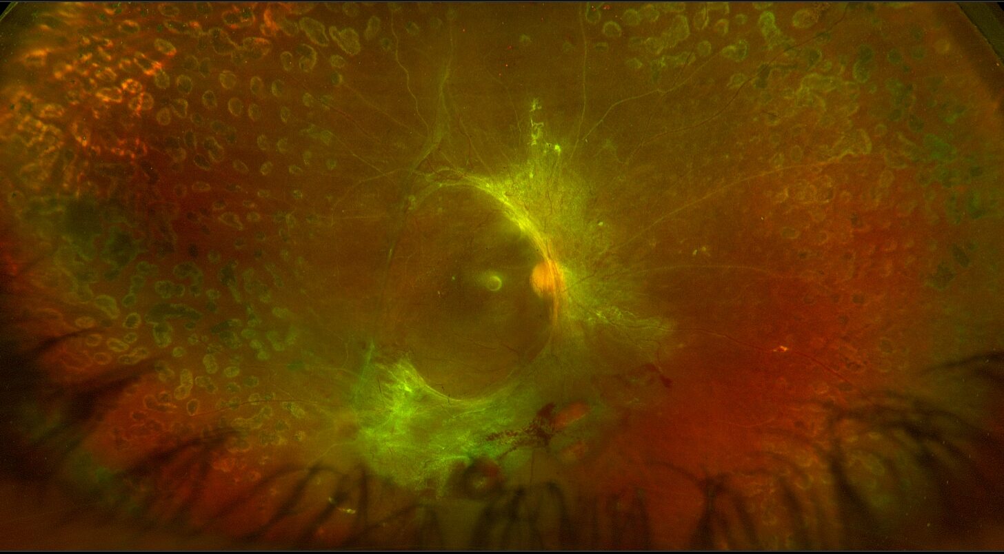 Retinal Detachment - MD Searchlight