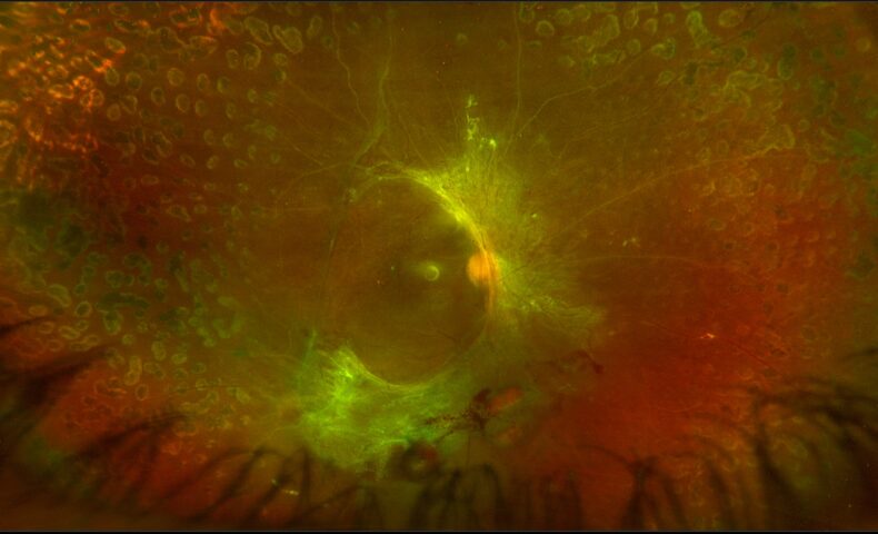 Visual Field Defects Archives - MD Searchlight