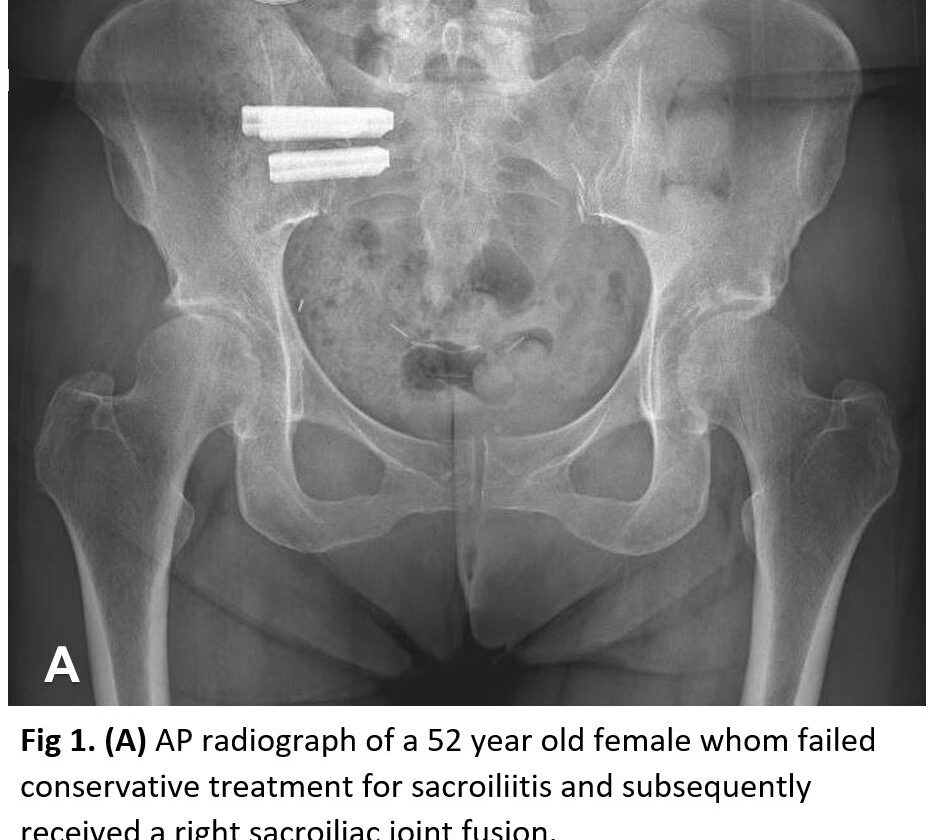 Sacroiliitis - MD Searchlight