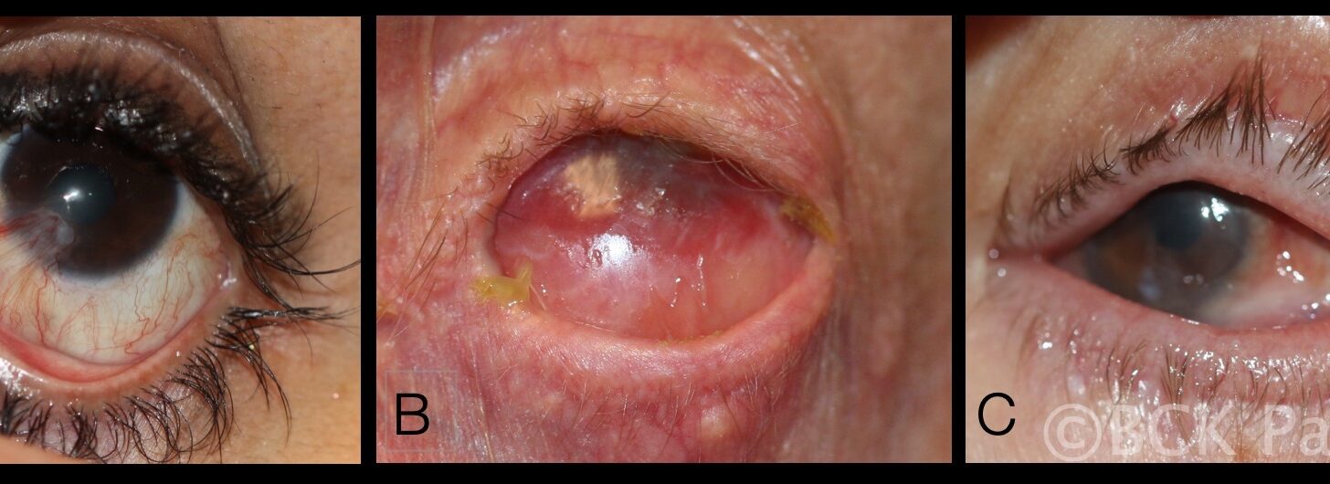 Ocular Pemphigoid - MD Searchlight