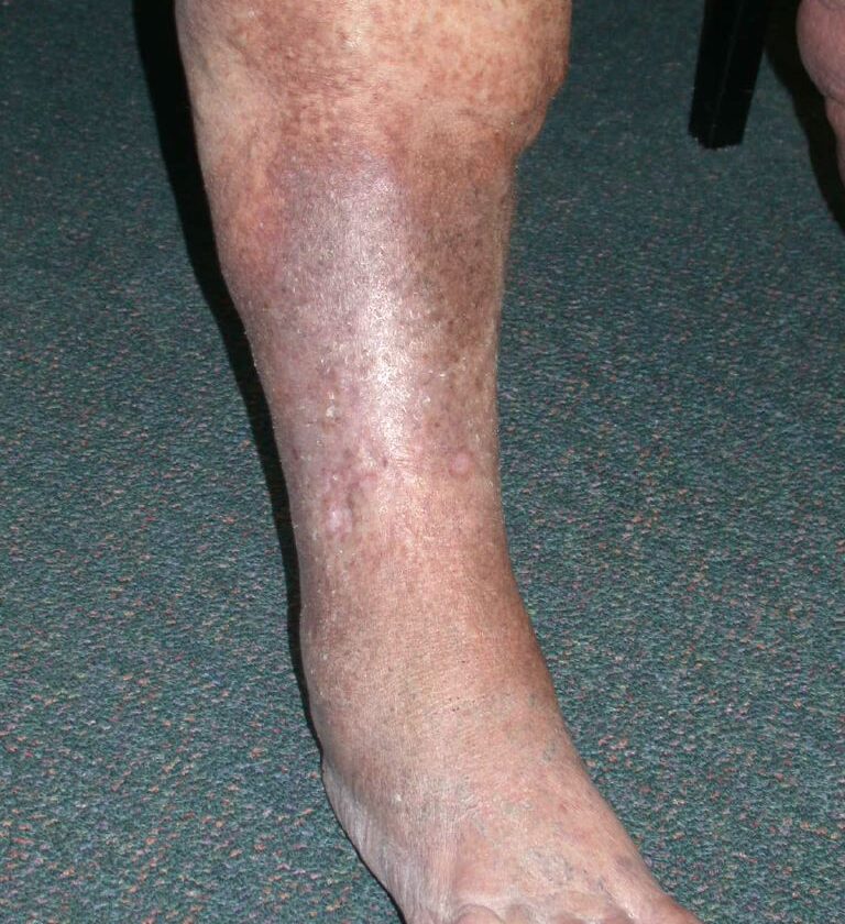 Lipodermatosclerosis - MD Searchlight