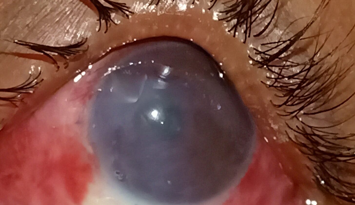 Ocular Burns - MD Searchlight
