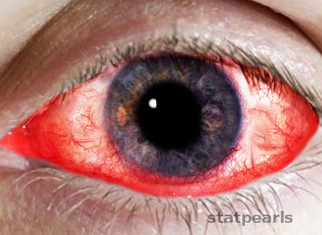 Keratoconjunctivitis - MD Searchlight