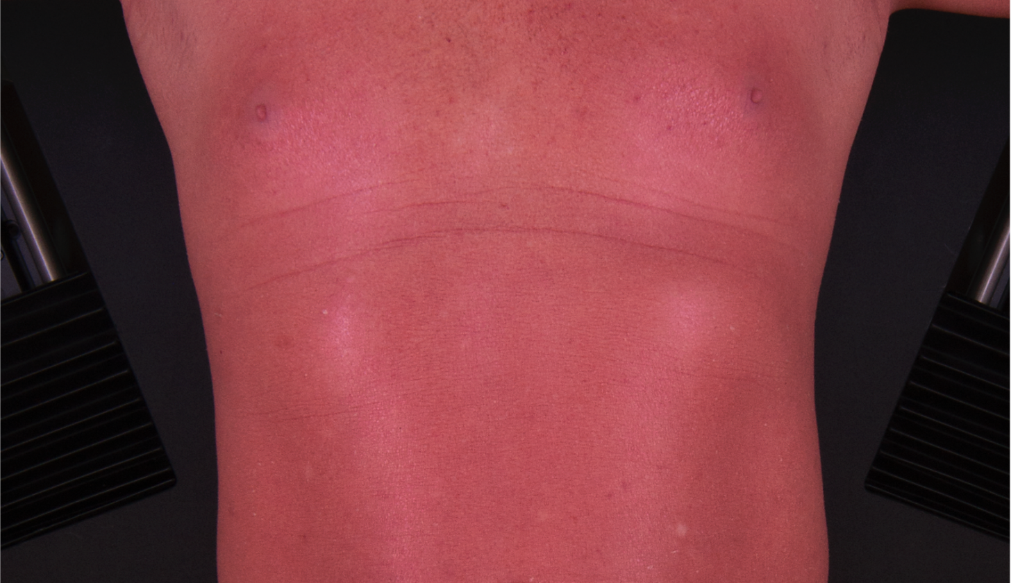 Pityriasis Rubra Pilaris - MD Searchlight