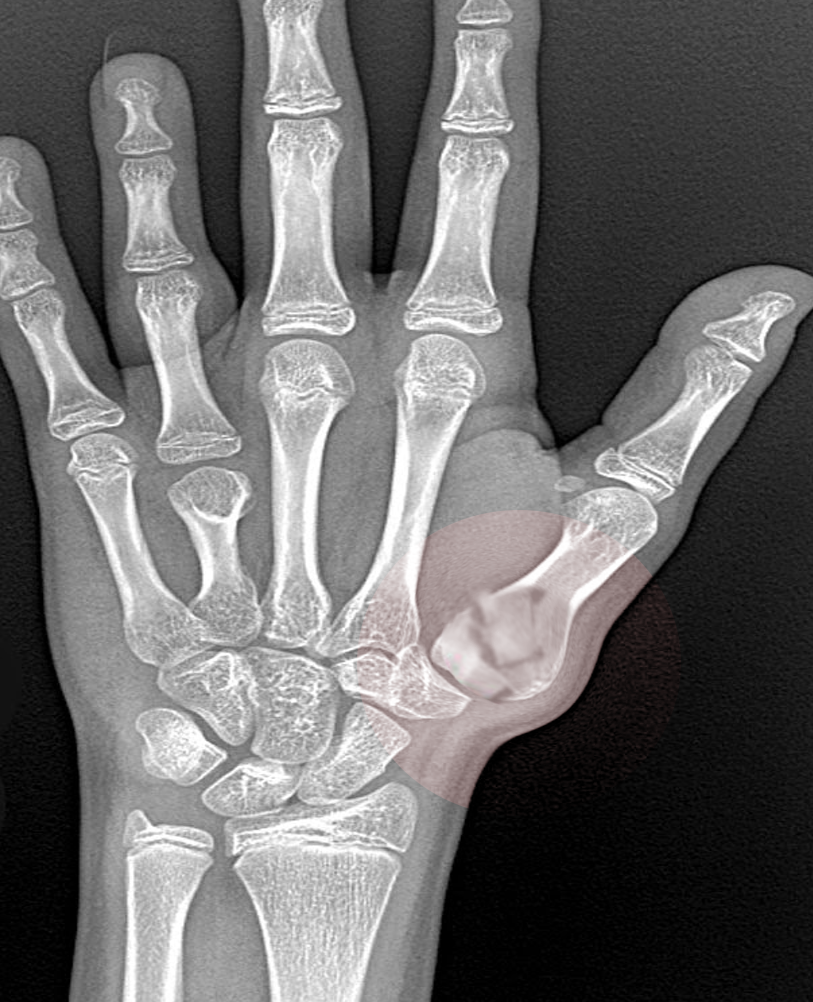 Bennett Fracture - MD Searchlight