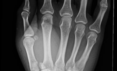 Bennett Fracture - MD Searchlight