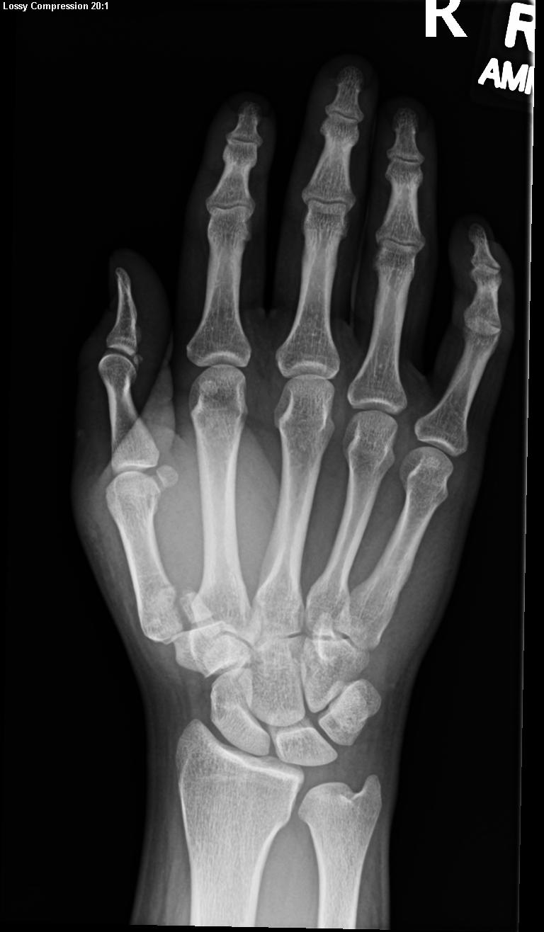 Bennett Fracture - MD Searchlight