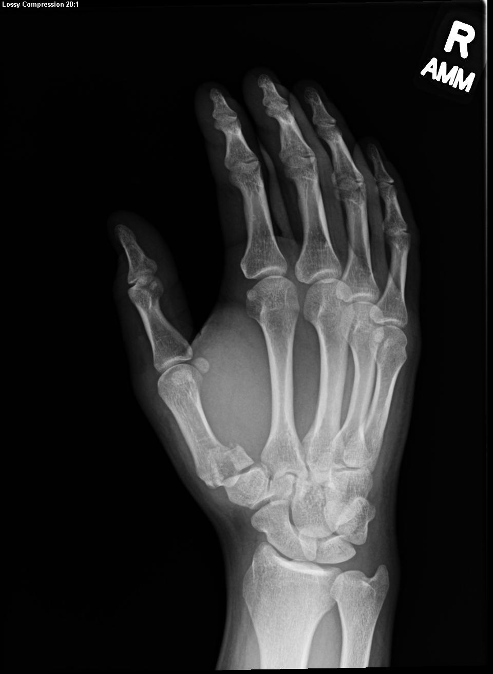 Bennett Fracture - MD Searchlight