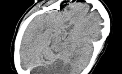 Posterior Cerebral Artery Stroke (Stroke) - MD Searchlight