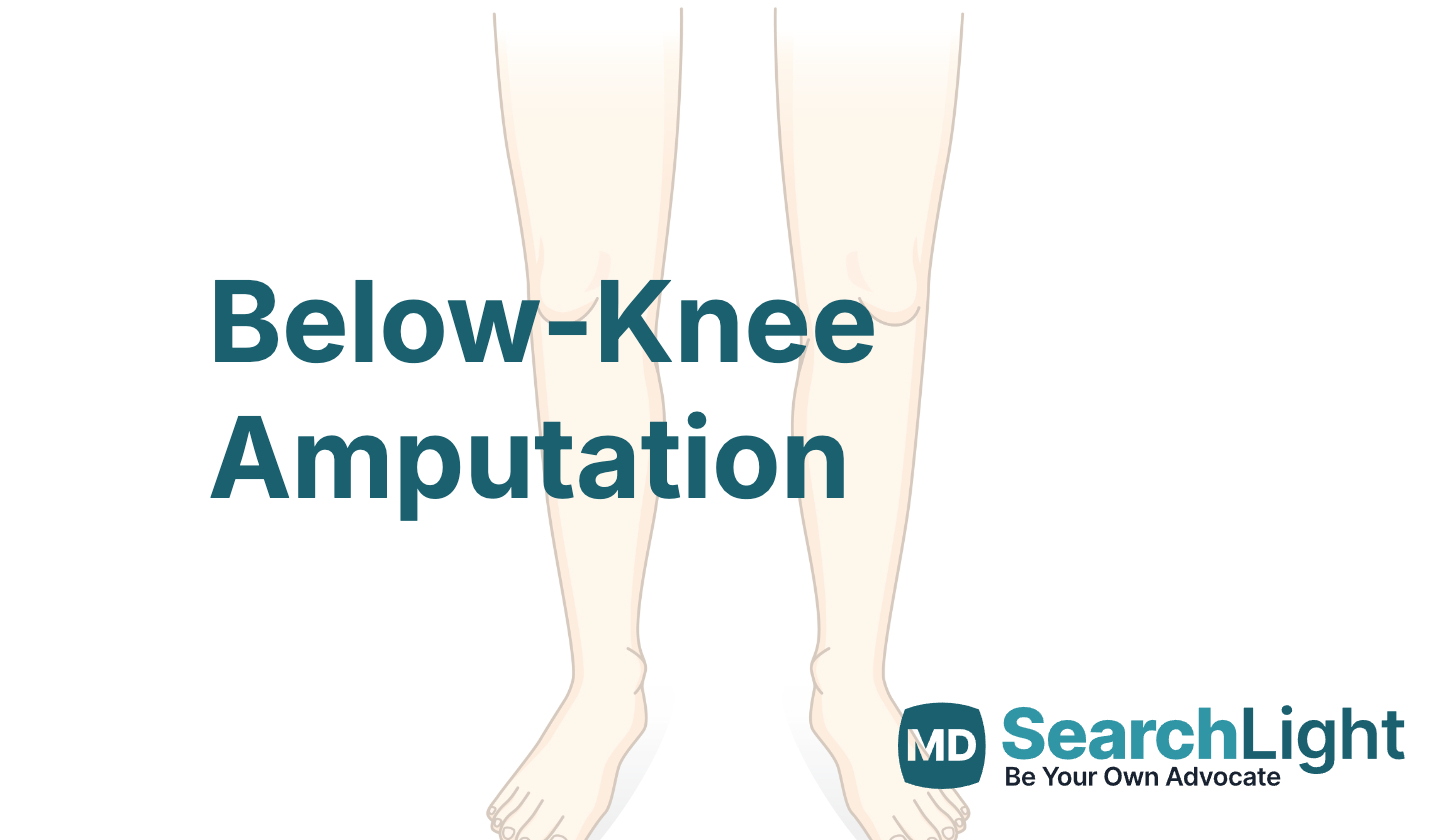 Below-Knee Amputation (Leg Amputation) - MD Searchlight