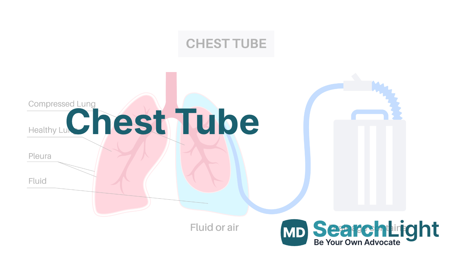 Chest Tube (Chest) - MD Searchlight