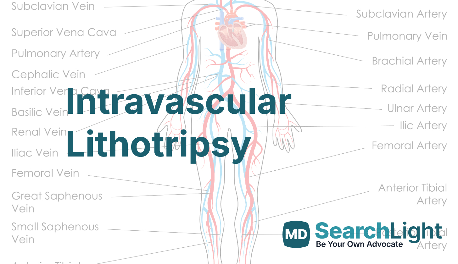 Intravascular Lithotripsy (Shockwave Lithotripsy) - MD Searchlight