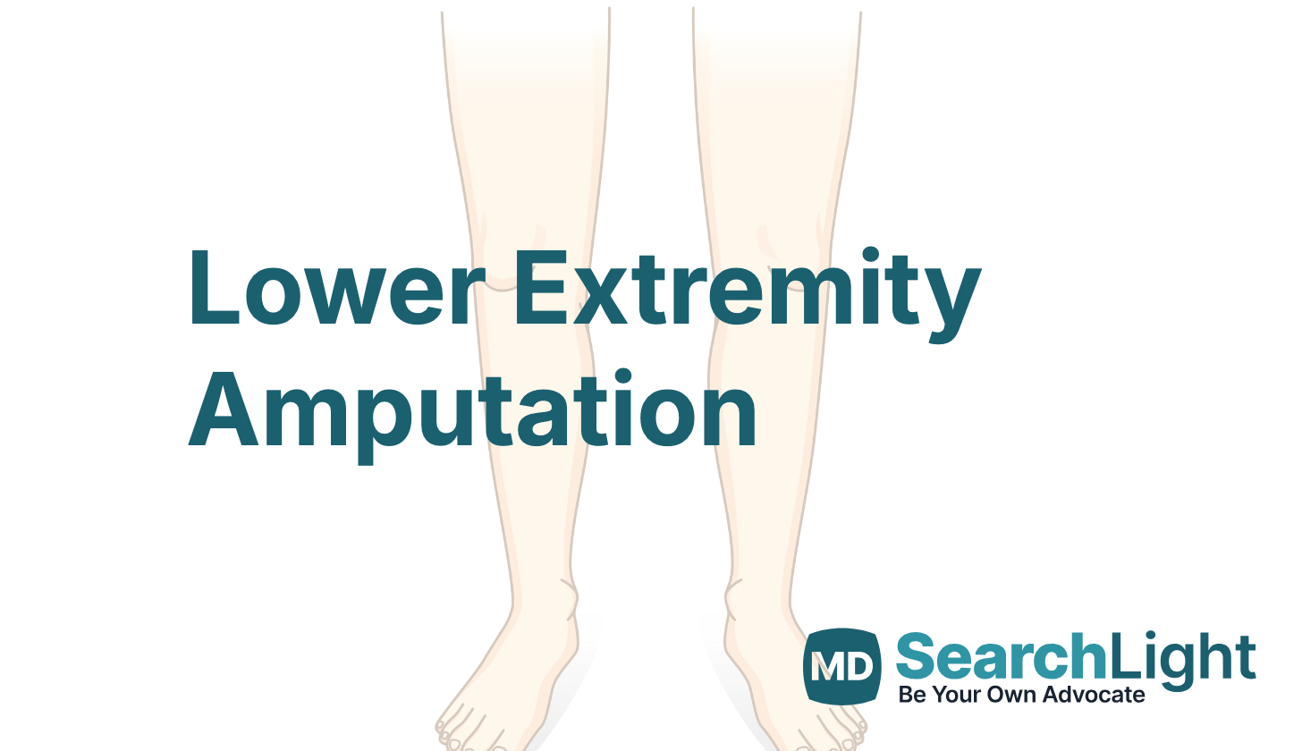 Lower Extremity Amputation (Amputation) - MD Searchlight