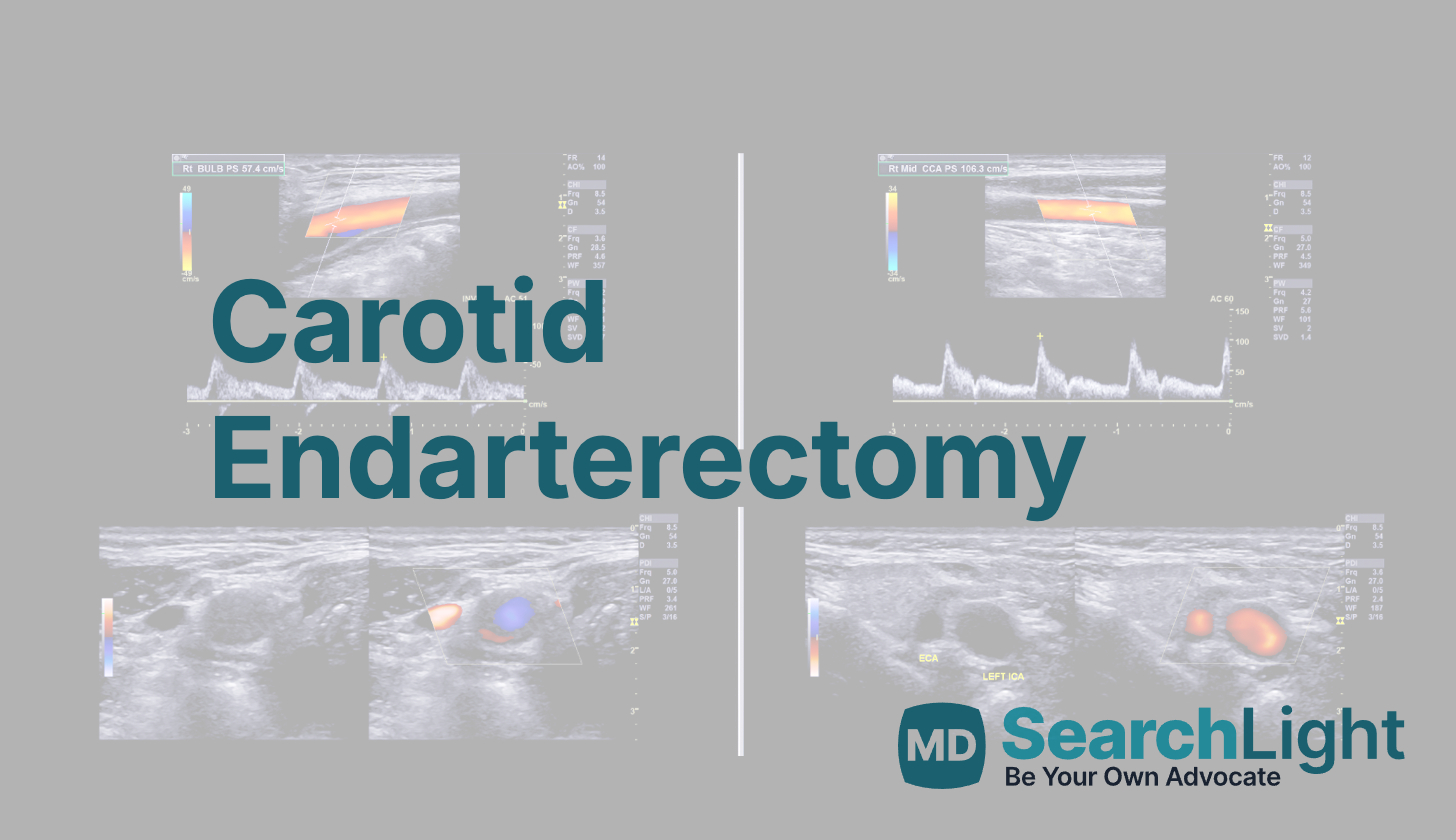 Carotid Endarterectomy (Carotid Artery Surgery) - MD Searchlight