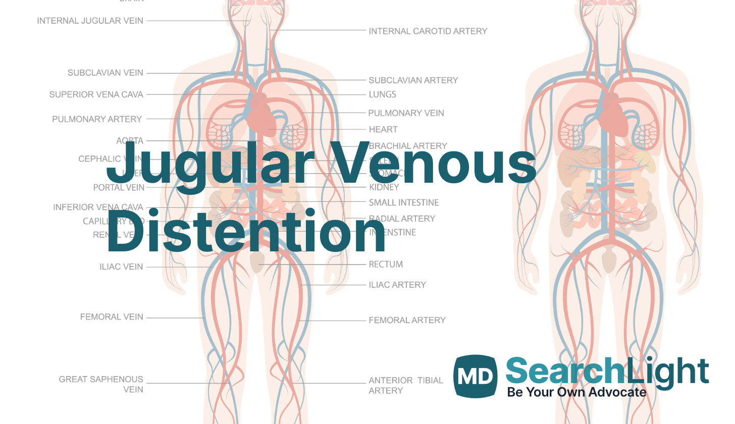 Jugular Venous Distention (JVD) - MD Searchlight