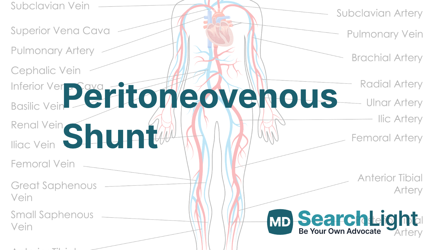 Peritoneovenous Shunt - MD Searchlight