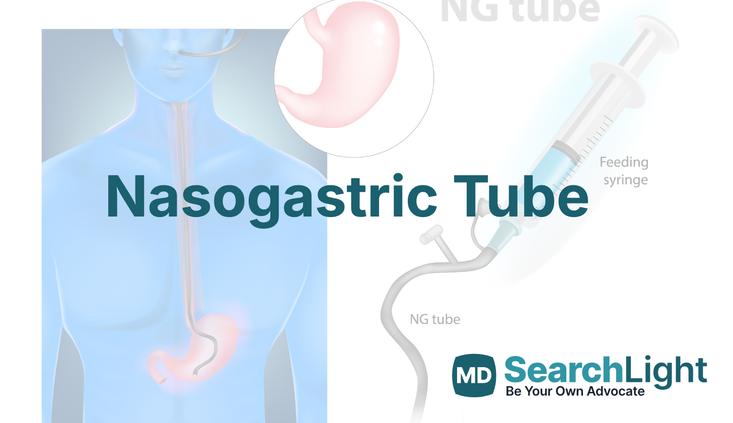Nasogastric Tube - MD Searchlight