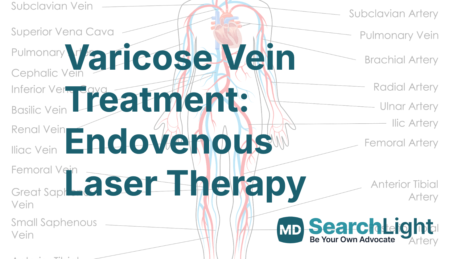 Varicose Vein Treatment: Endovenous Laser Therapy (Endovenous Laser Therapy) - MD Searchlight