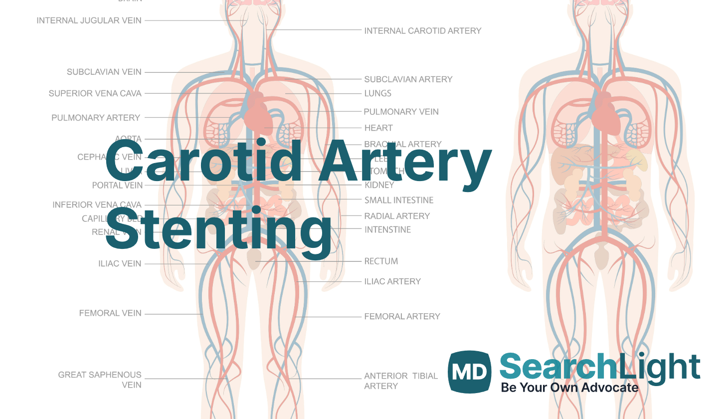 Carotid Artery Stenting (Carotid Stent Procedure) - MD Searchlight